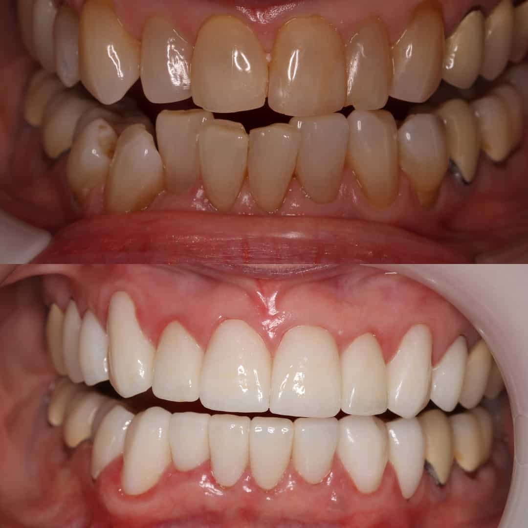 Correction Without Ortho - Smile Sarasota